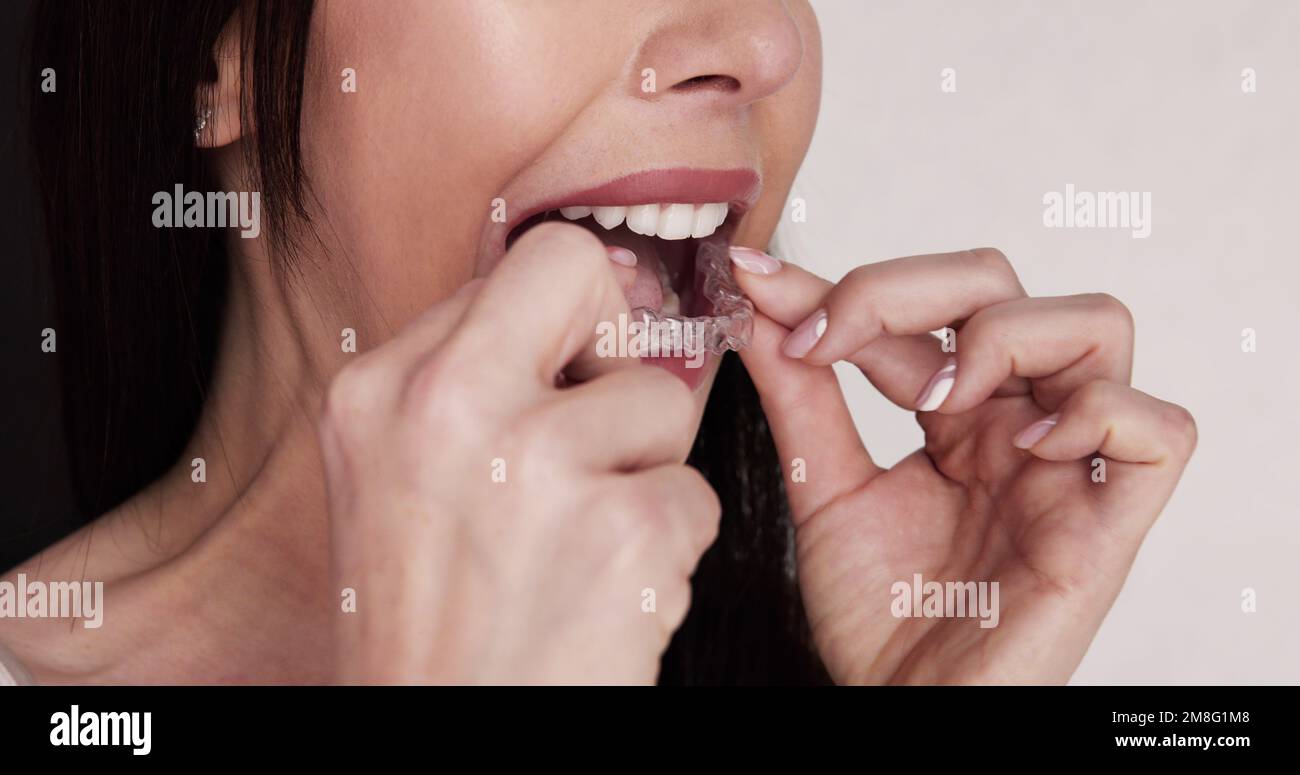 Clear Aligner Dental Night Guard For Teeth Stock Photo - Alamy