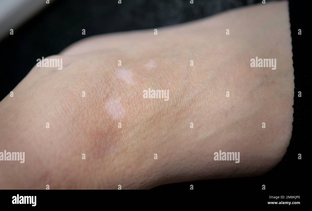 Close-up of several fading white vitiligo skin patches on the left foot ...
