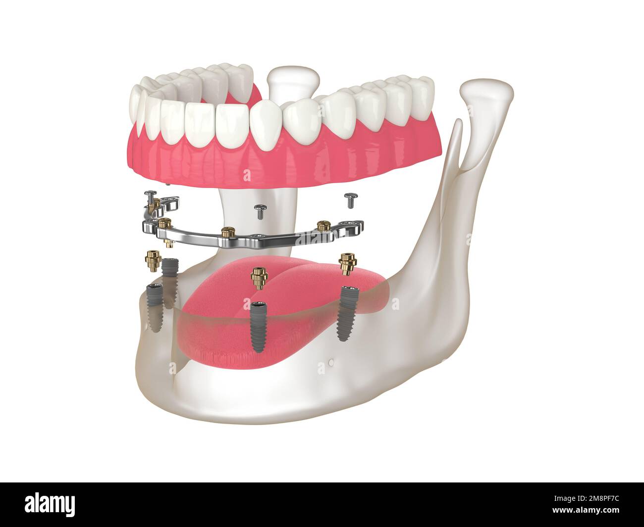 3d render of bar retained removable overdenture installation supported ...