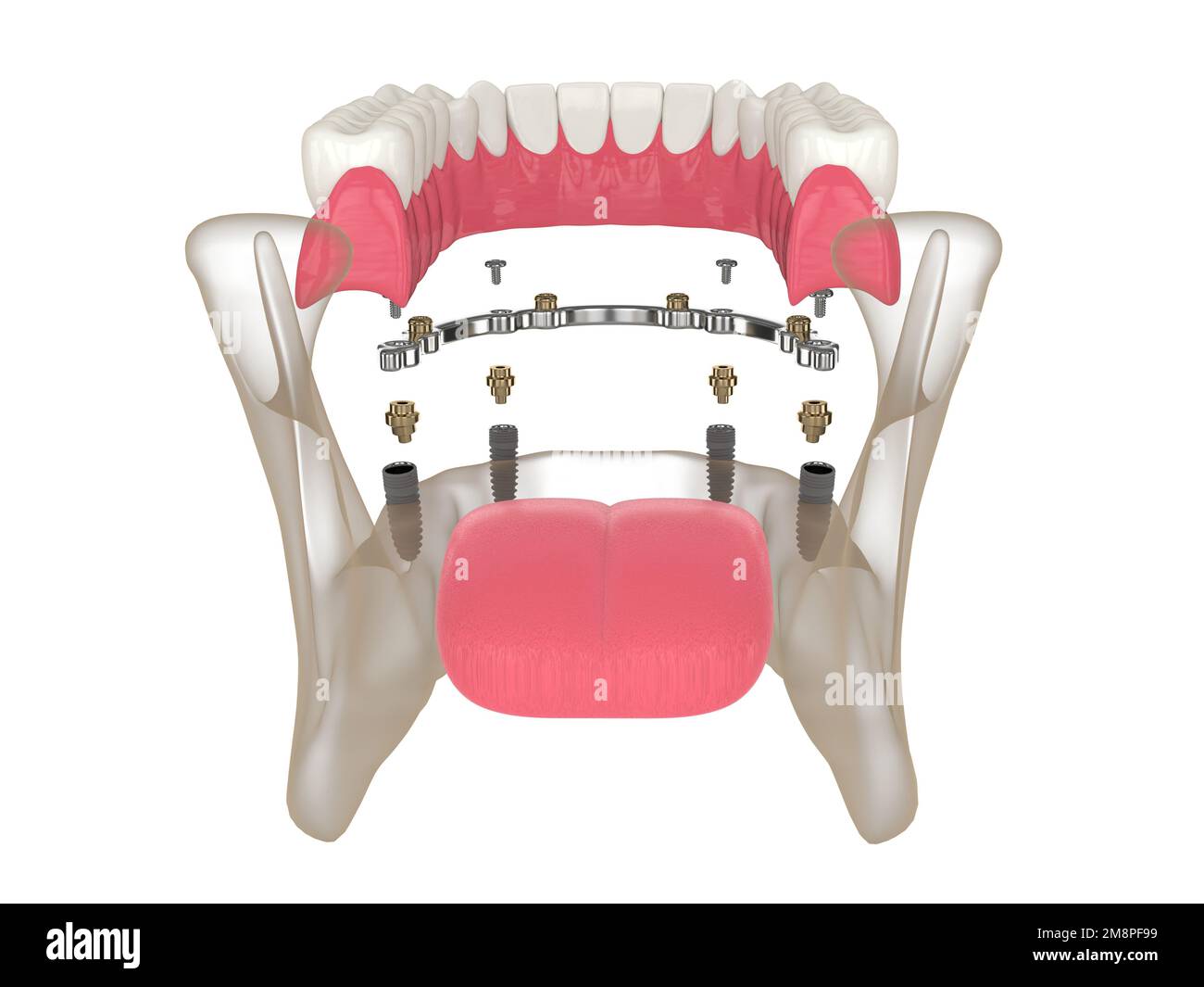 3d render of bar retained removable overdenture installation supported ...