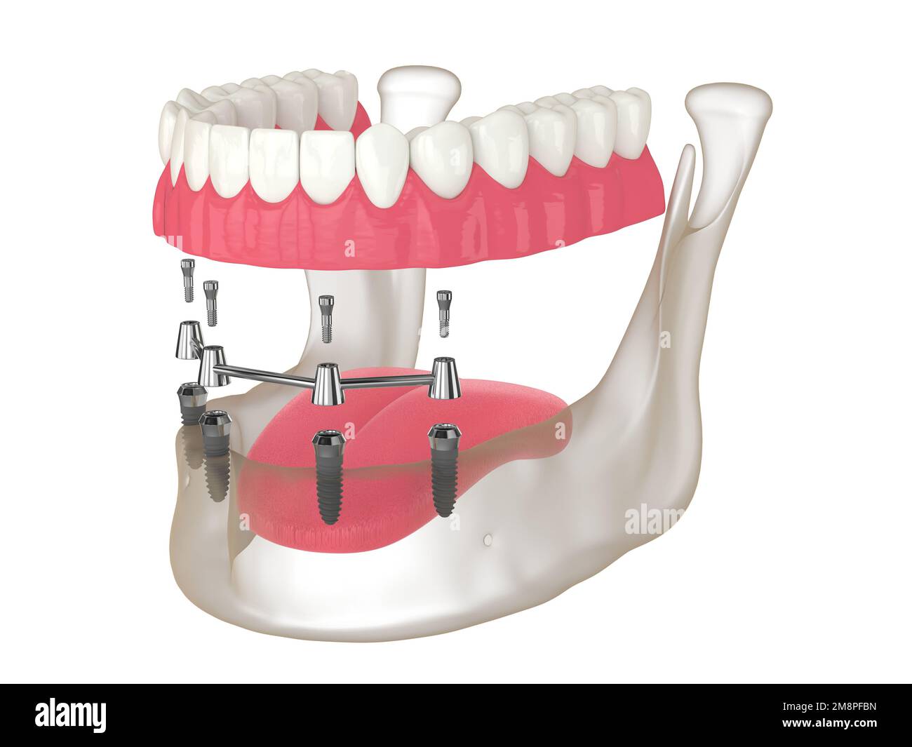 3d render of bar retained removable overdenture installation supported ...
