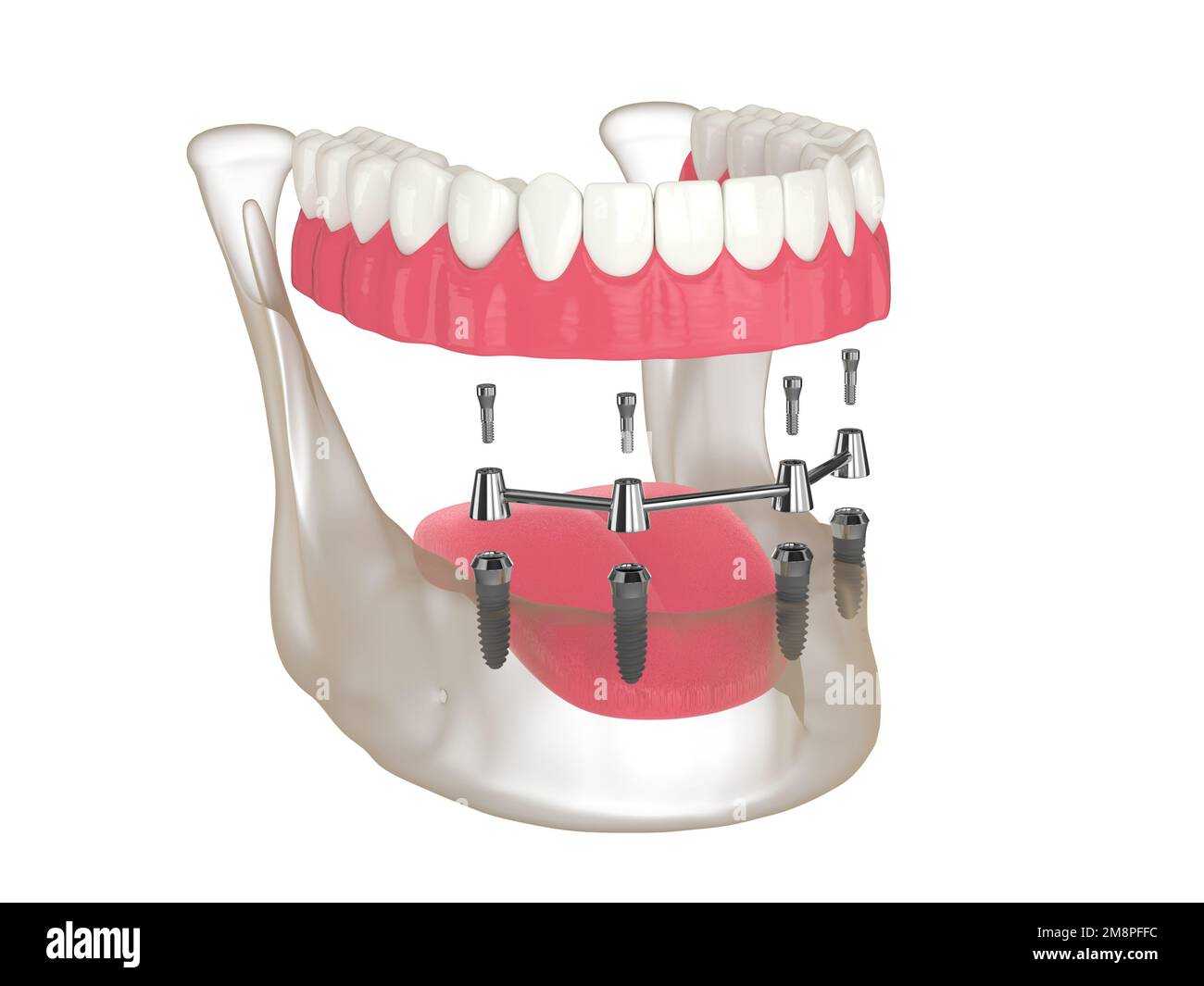 3d render of bar retained removable overdenture installation supported ...