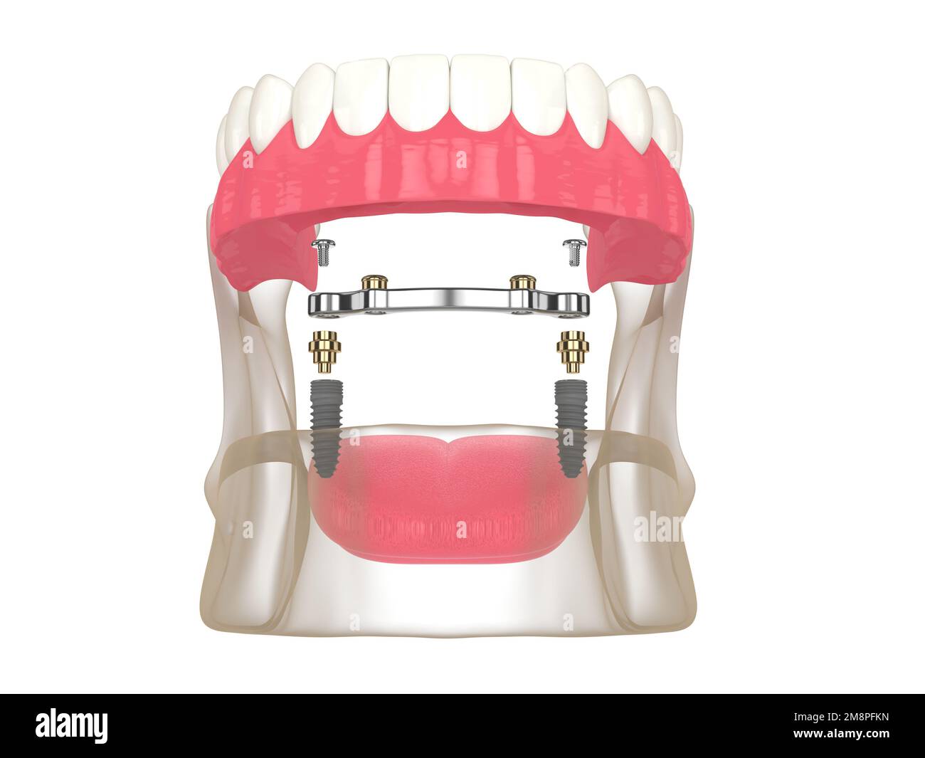 3d render of bar retained removable overdenture installation supported ...