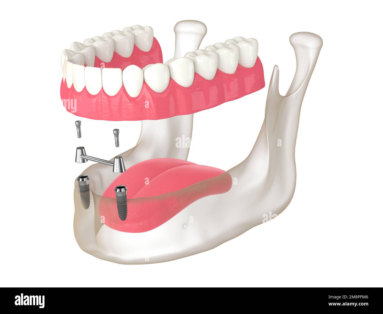 3d render of removable overdenture installation on bar clip attachment ...