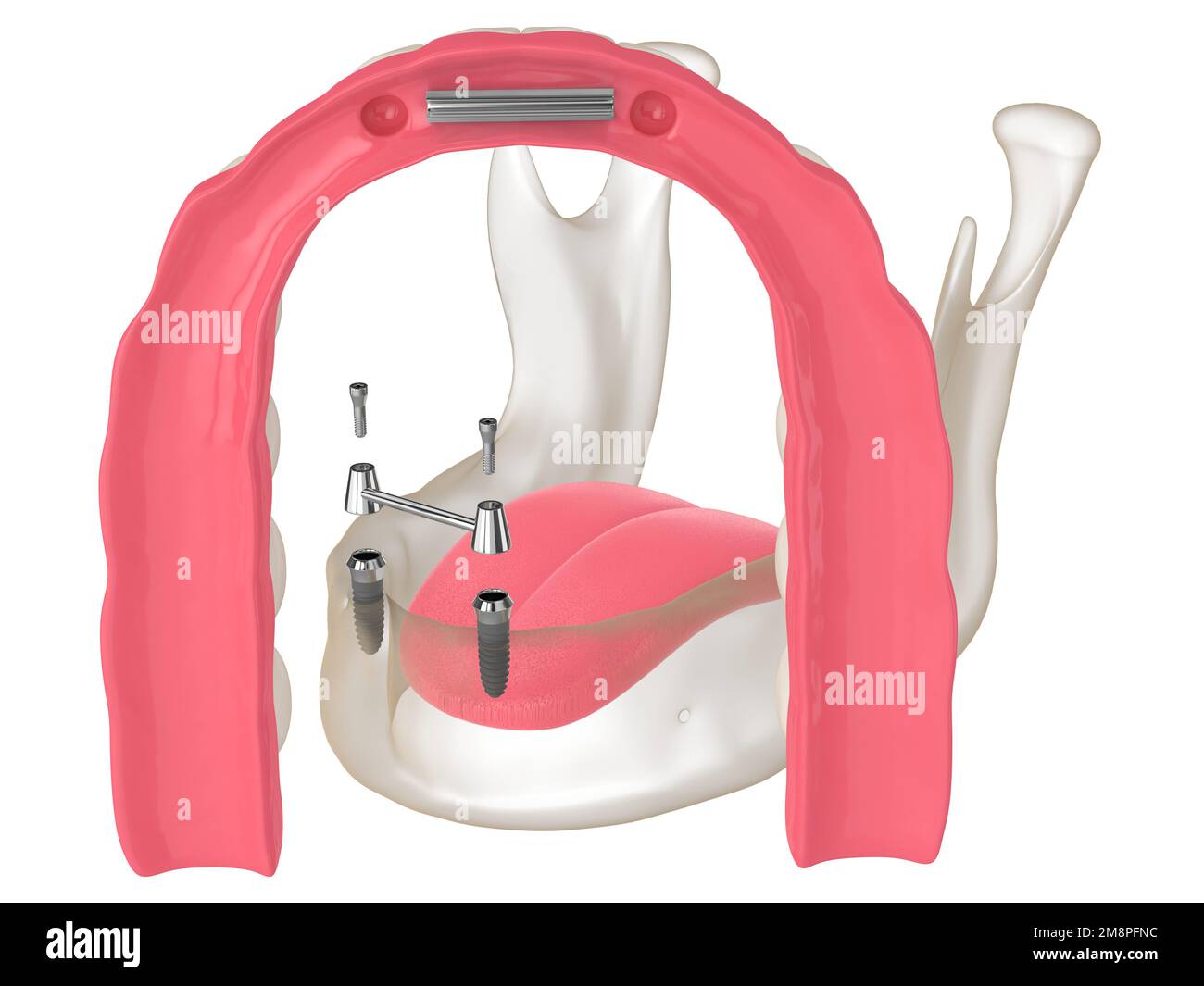 3d render of removable overdenture installation on bar clip attachment ...