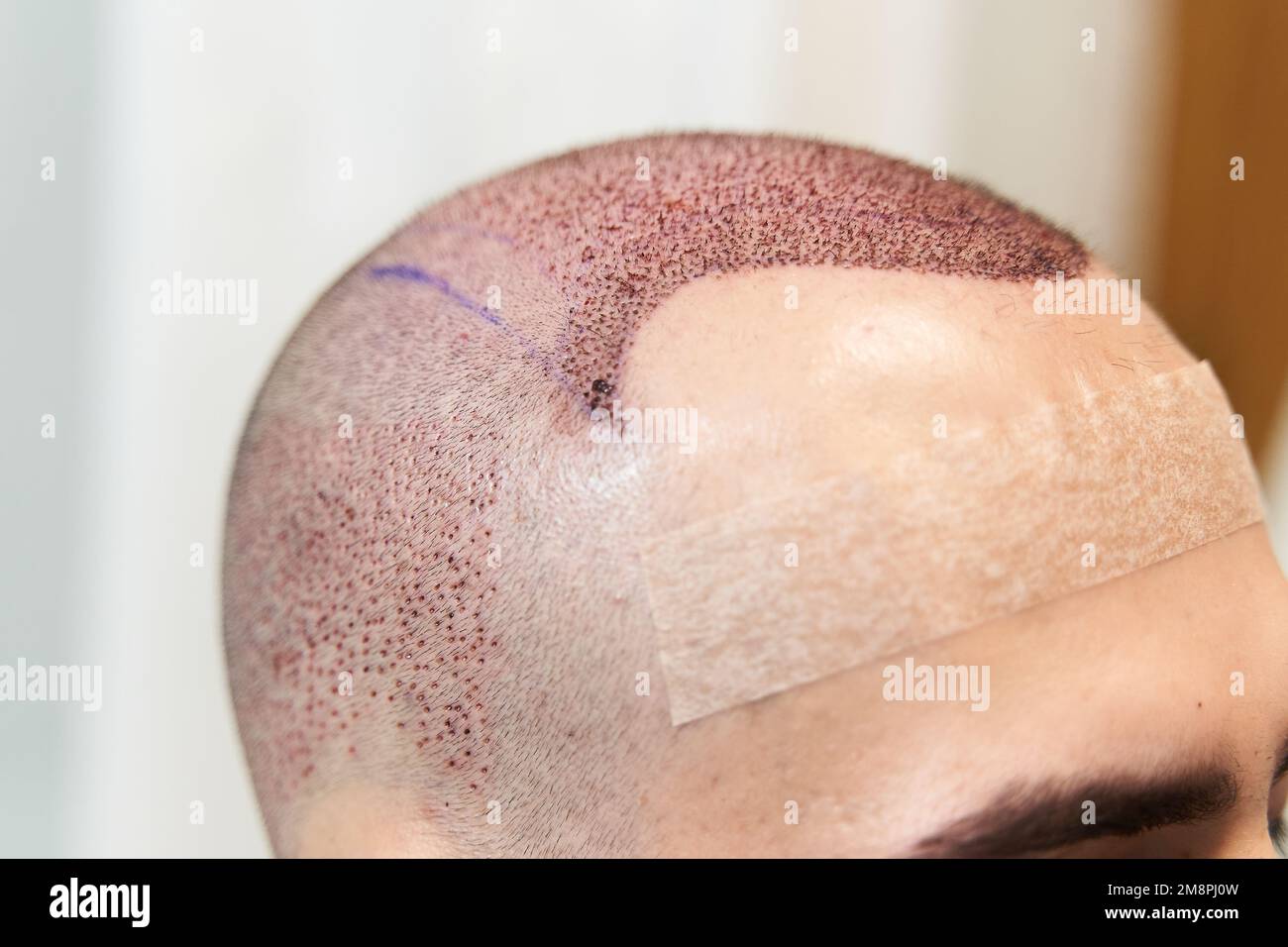 End to baldness concept. Male scalp after hair implant surgery Stock ...