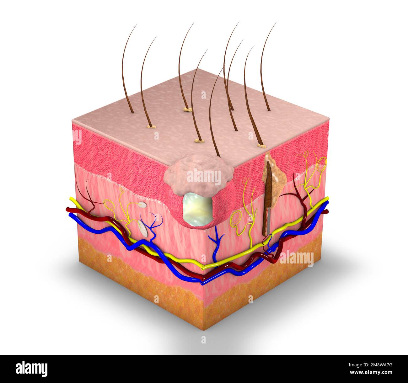 Section of skin with cyst, subcutaneous swelling. Pilar cyst and ...