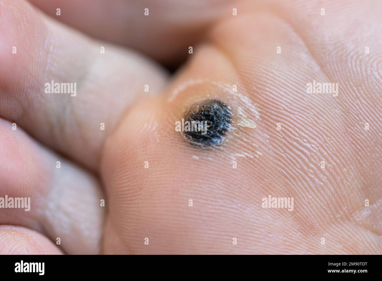 Closeup Of Wart Plantar After Cauterizing It With Celandine On Infected Foot Papillomavirus Or