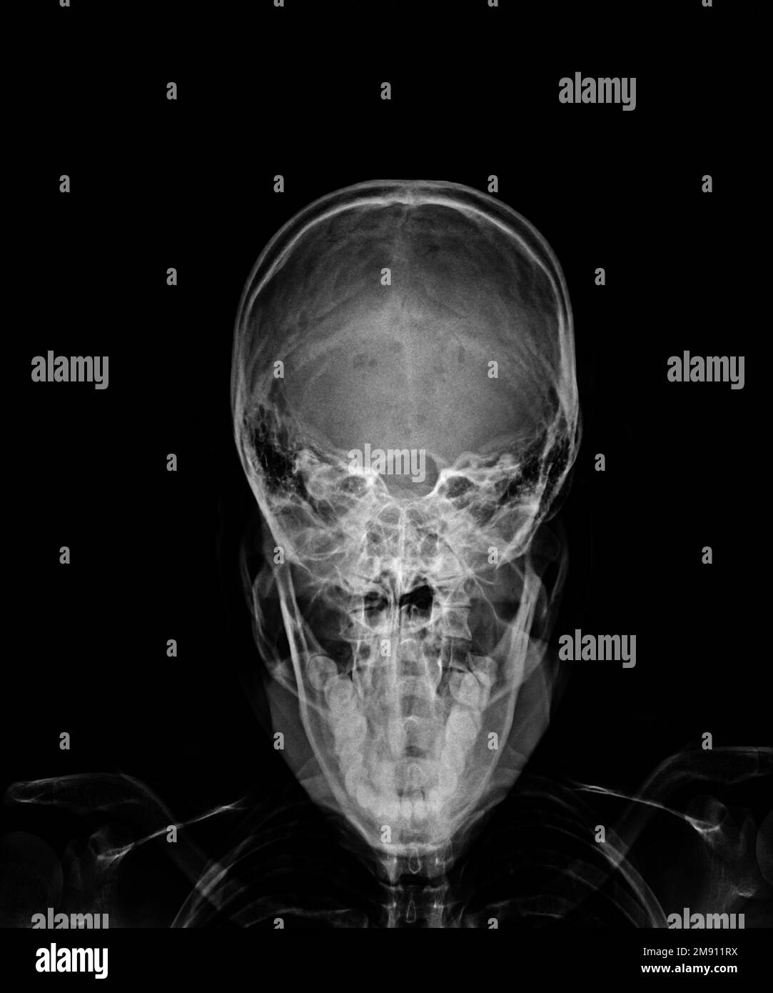 X-ray film of the skull Stock Photo - Alamy