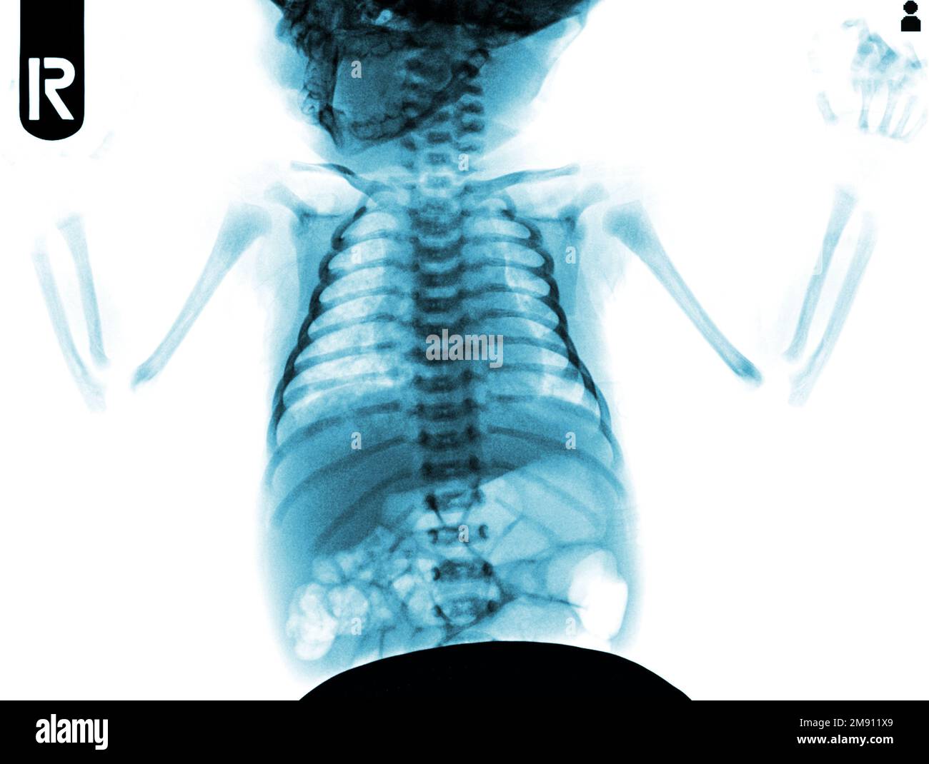 Foreshortened Hand X Ray