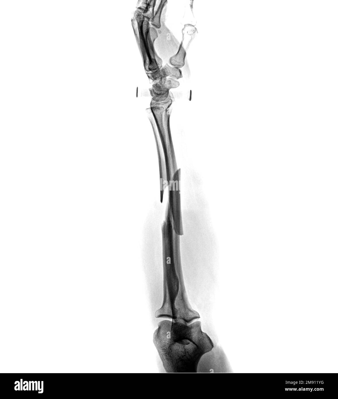 Fracture bone scan Black and White Stock Photos & Images - Alamy