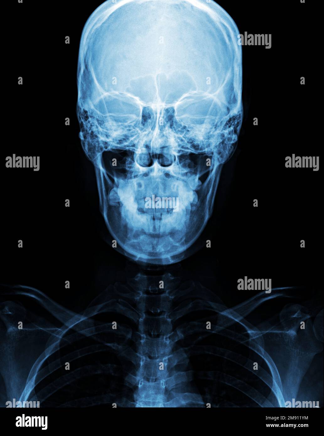 X-ray film of the skull Stock Photo - Alamy