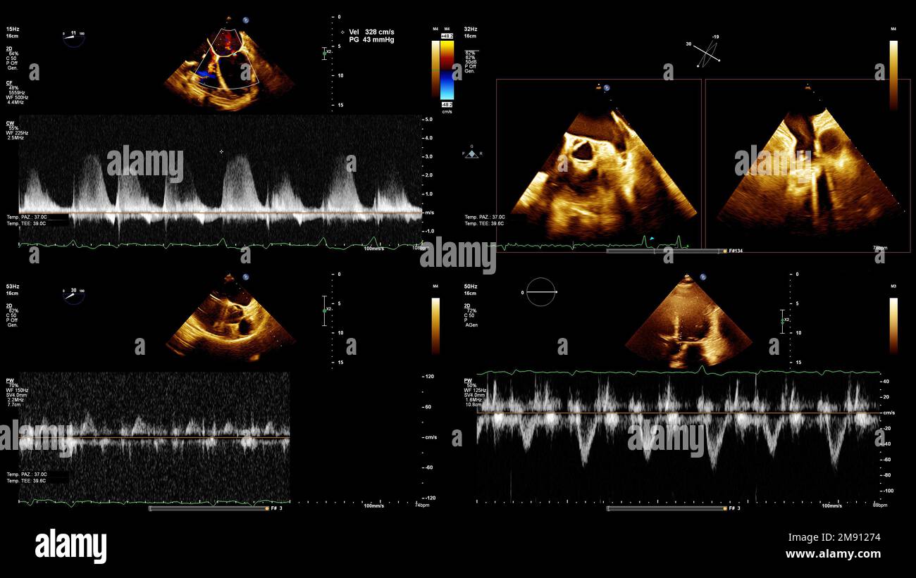 Transesophageal echocardiogram hi-res stock photography and images - Alamy