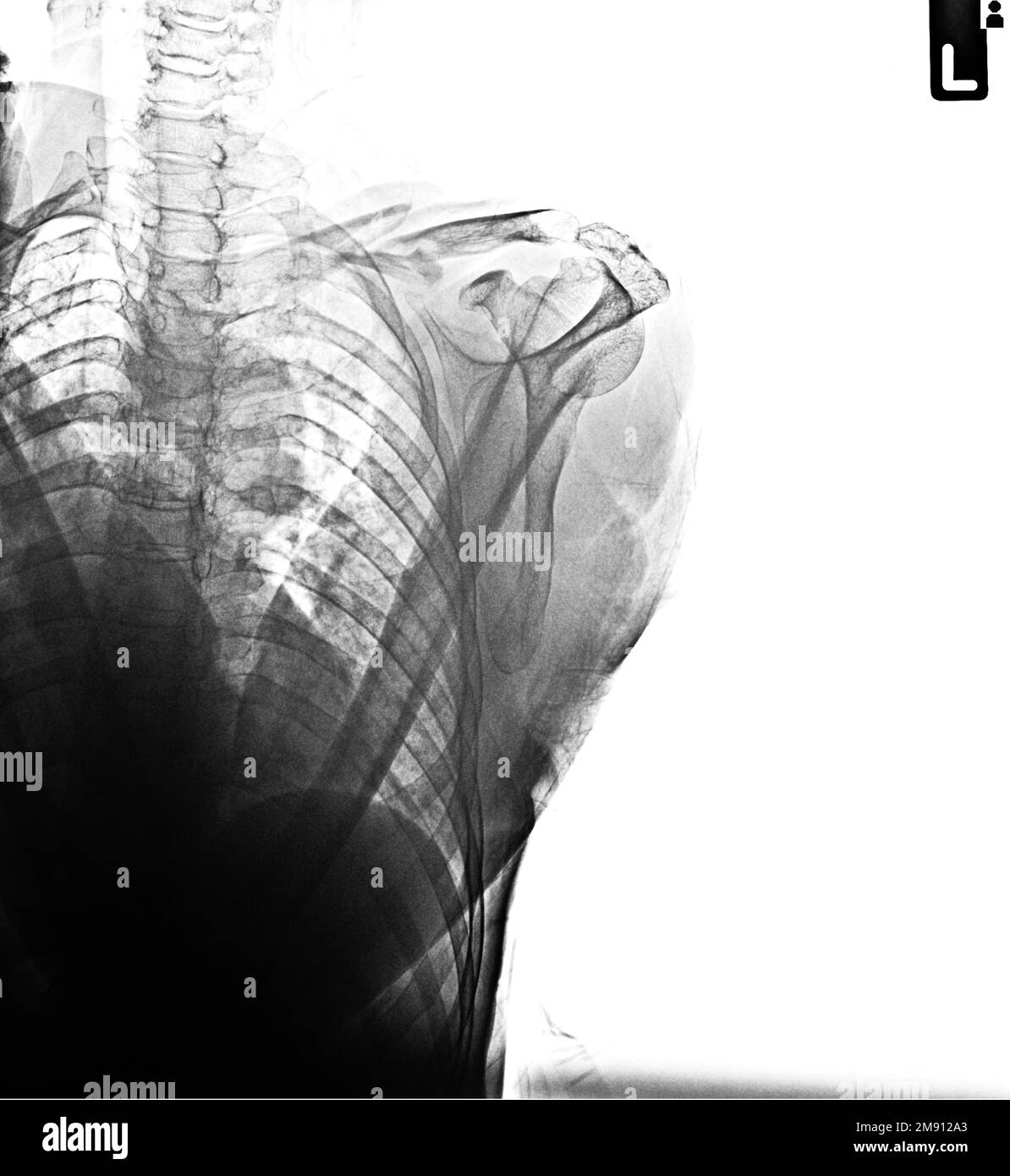 Humerus fracture x ray Black and White Stock Photos & Images - Alamy