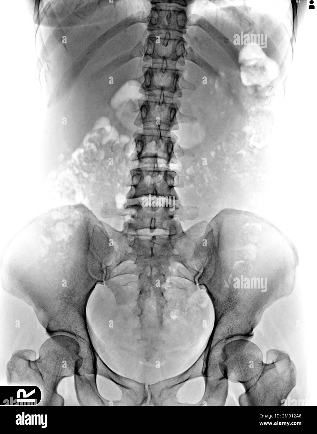 Abdomen, X ray abdomen Stock Photo - Alamy