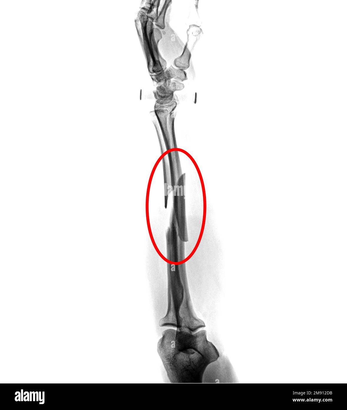 film X-ray fracture forearm Stock Photo - Alamy