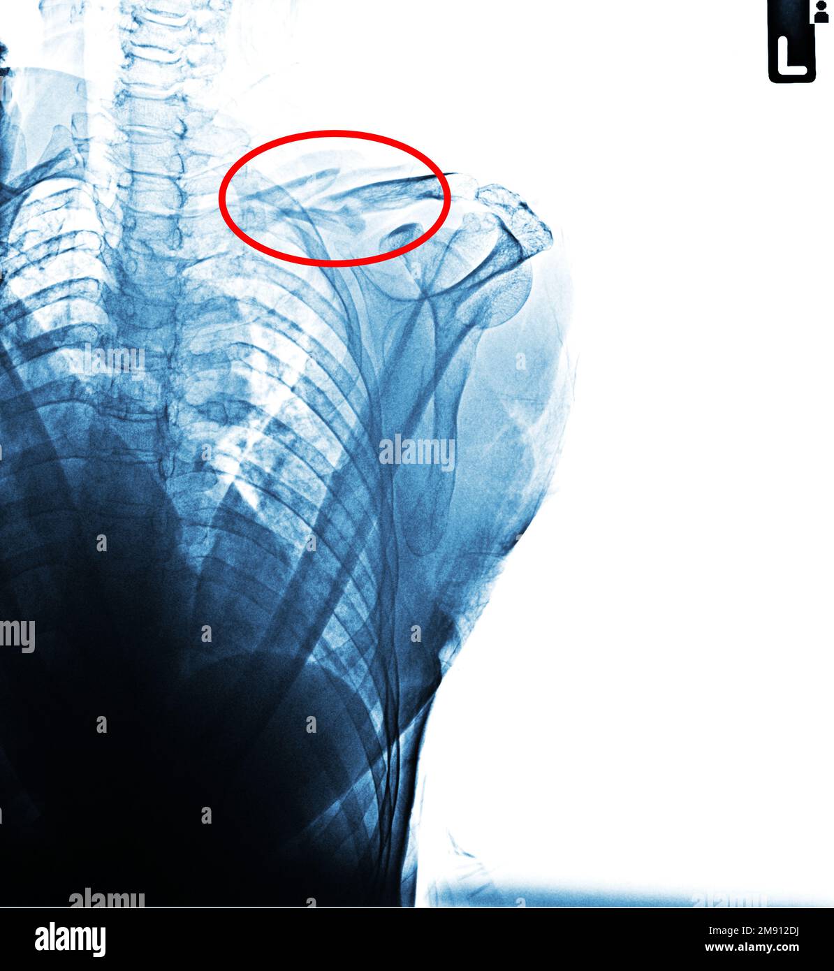 Film x-ray clavicle AP show fracture clavicle bone Stock Photo - Alamy