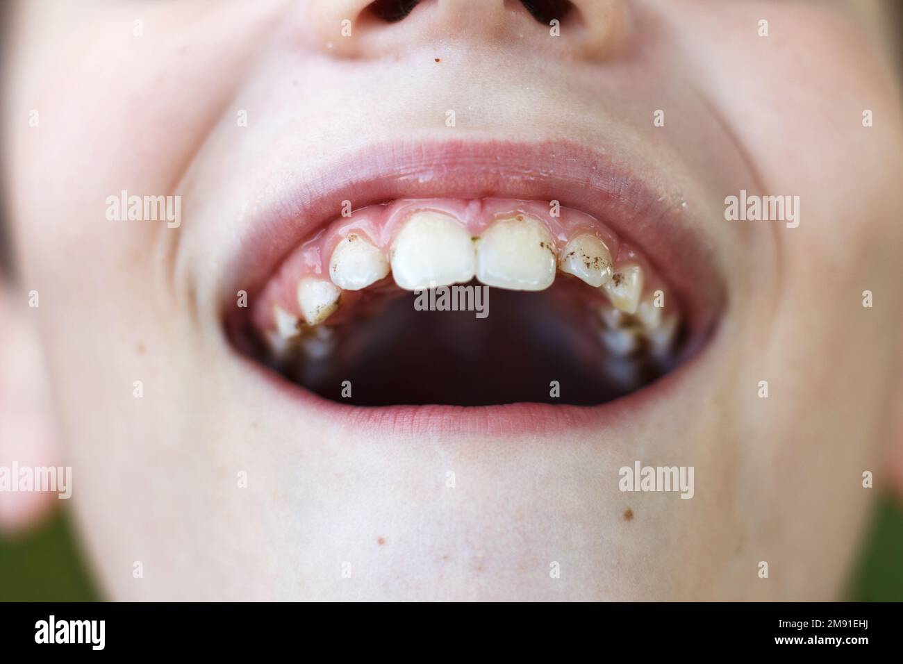 Teeth cavity open mouth hi-res stock photography and images - Alamy