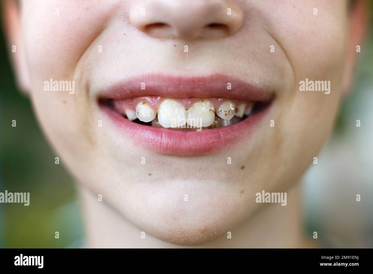 open mouth of a child boy with plaque or calculus on the teeth close ...