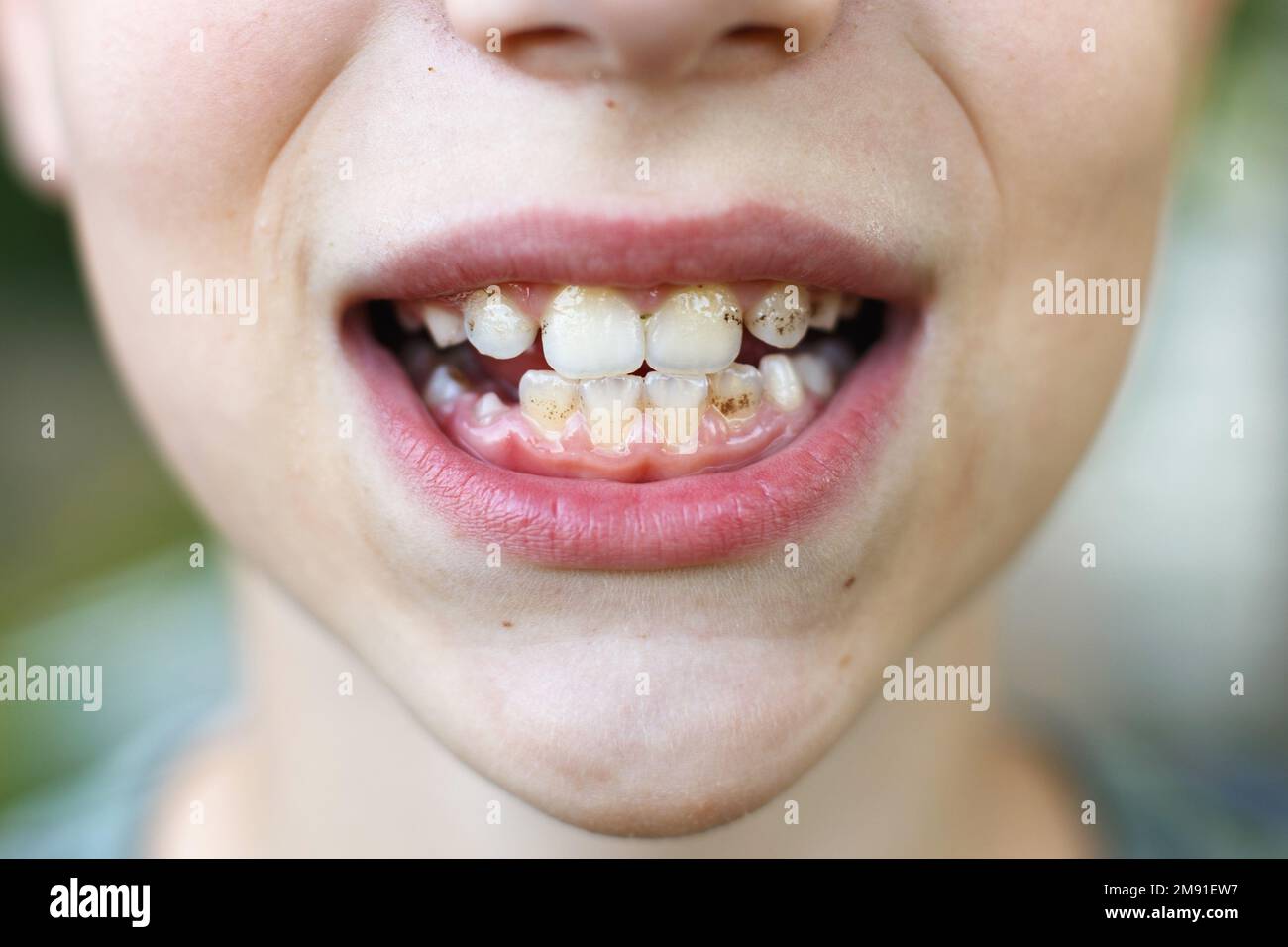 open mouth of a child boy with plaque or calculus on the teeth close ...