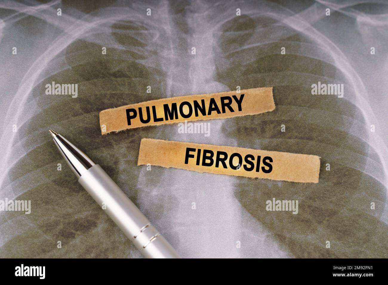 Medical concept. On a human chest x-ray, a pen and strips of paper ...
