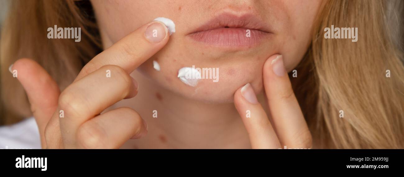 Unrecognizable woman applies makeup, cream serum cure for acne on face ...