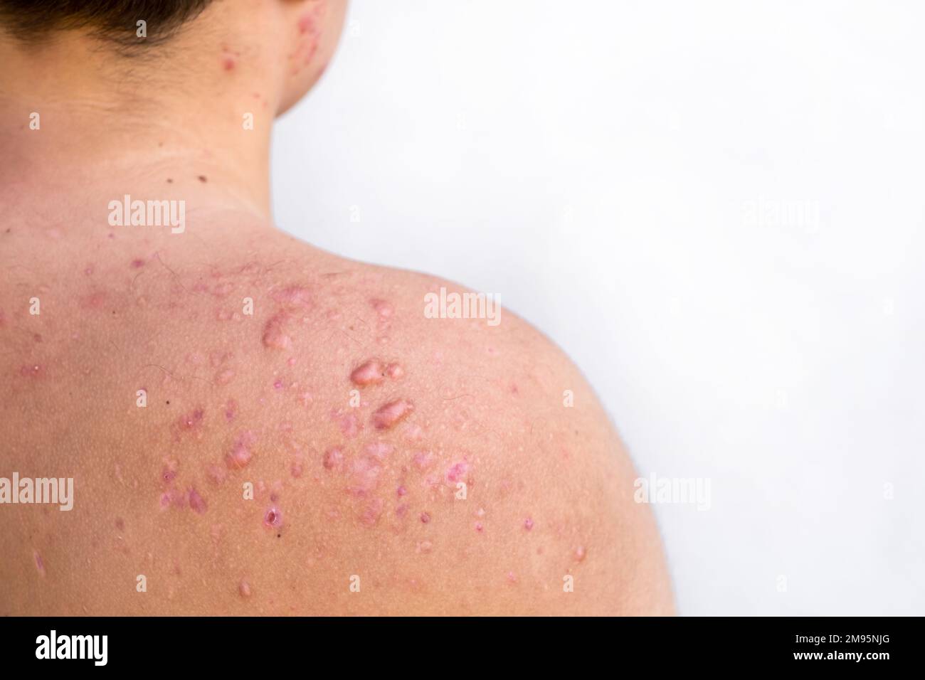 Acne Scars On Shoulders And Back