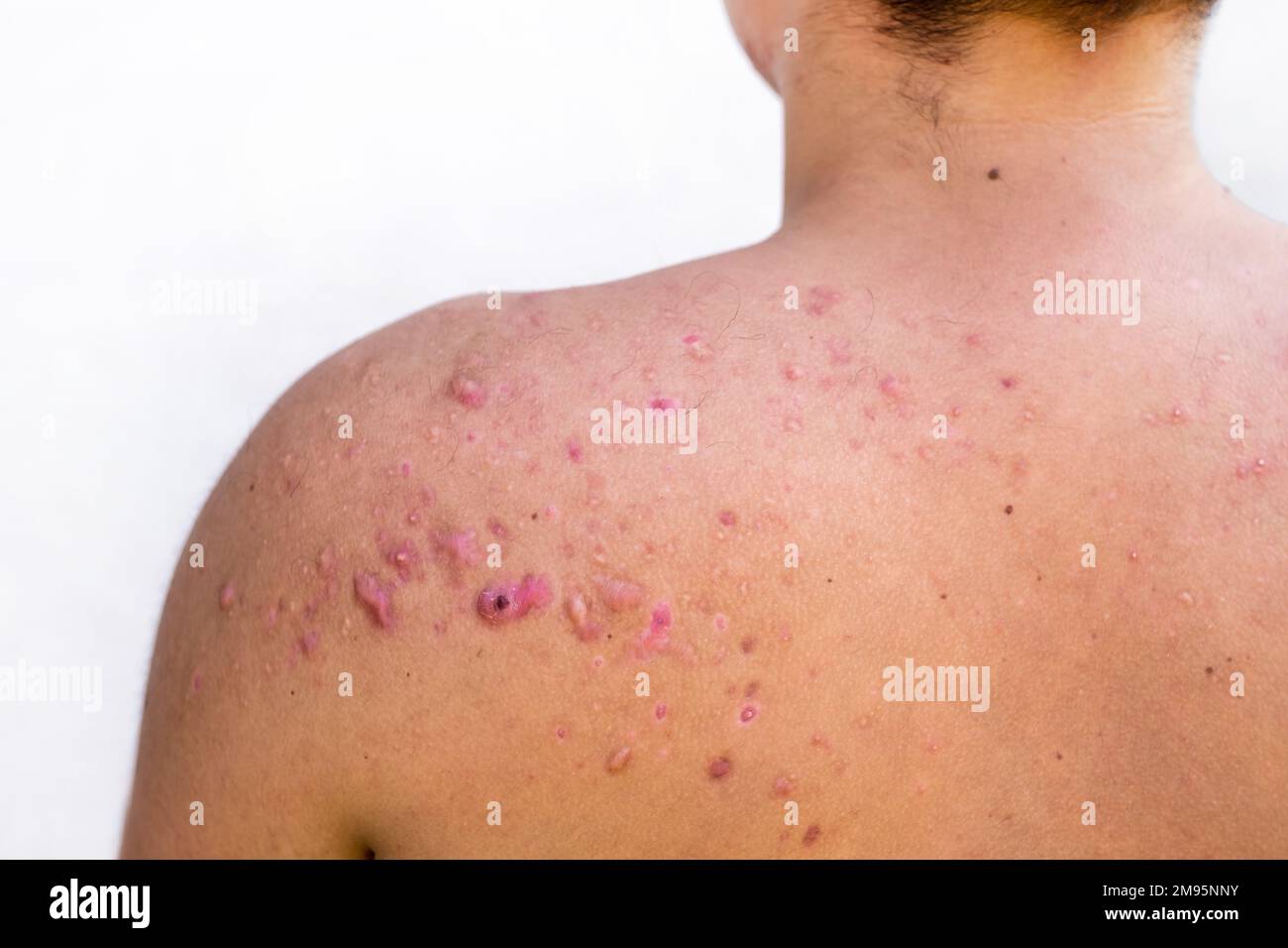 occipital acne in a teenage boy healed, scars from teenage acne on the ...