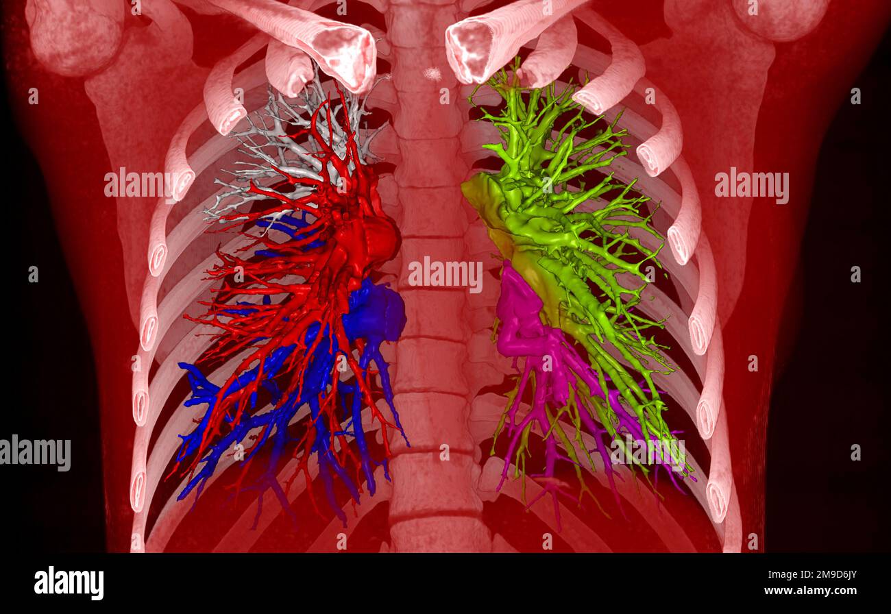 Healthy lungs, CT scan Stock Photo - Alamy