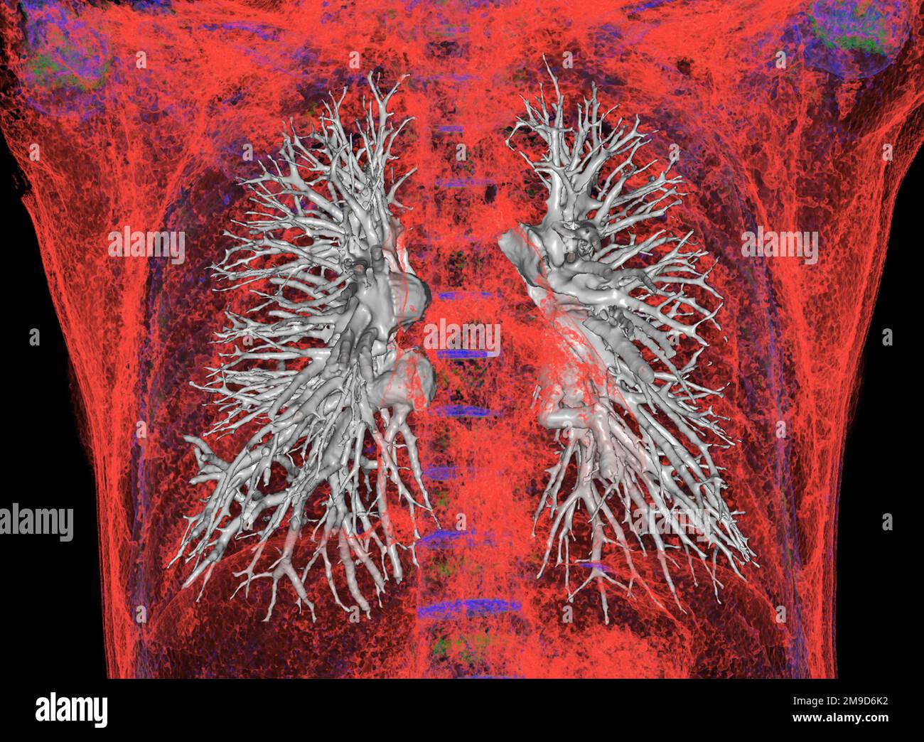 Healthy lungs, CT scan Stock Photo - Alamy