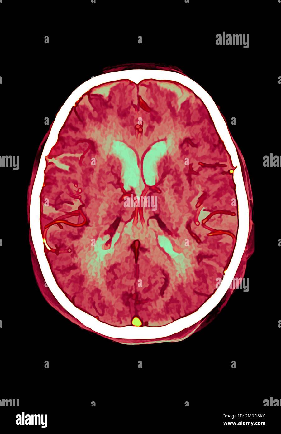 Cerebral arteries, CT scan Stock Photo - Alamy