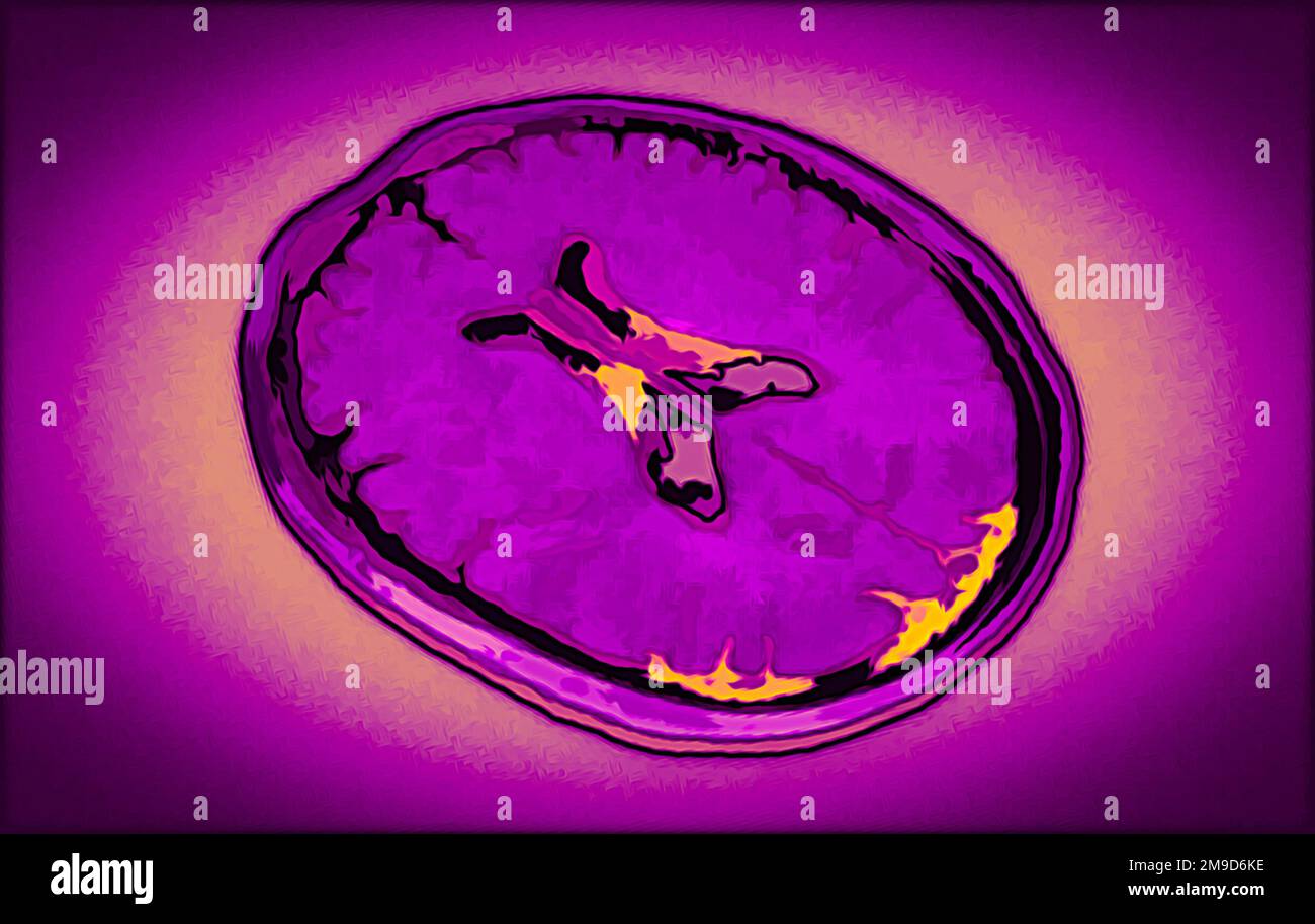 Spect Ct Scan Brain Ct Scan Machine
