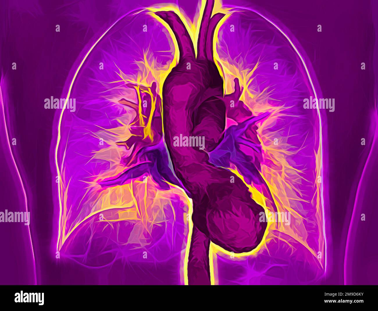 Prosthetic aortic graft replacement, CT scan Stock Photo - Alamy