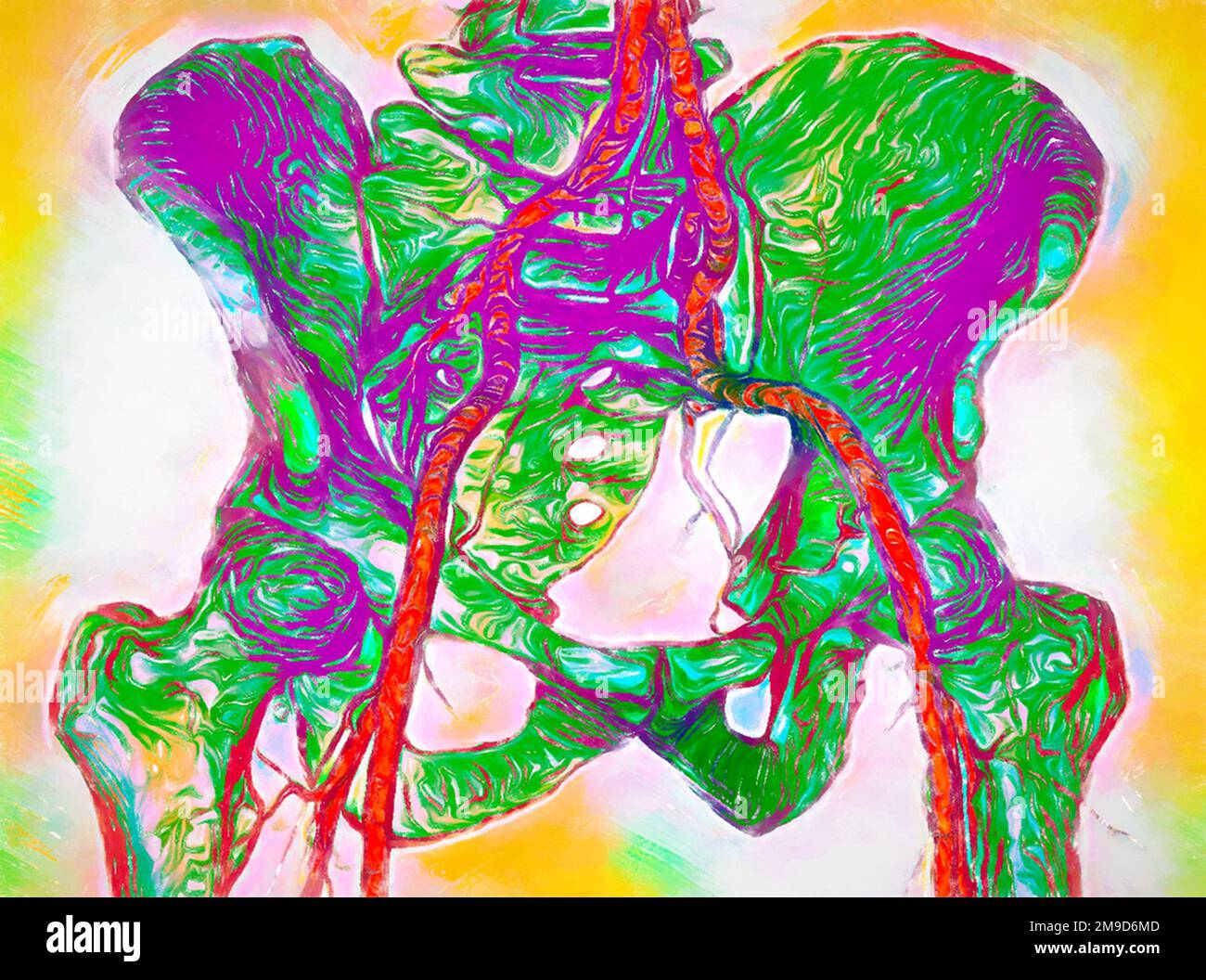 Iliac arteries, CT scan Stock Photo - Alamy
