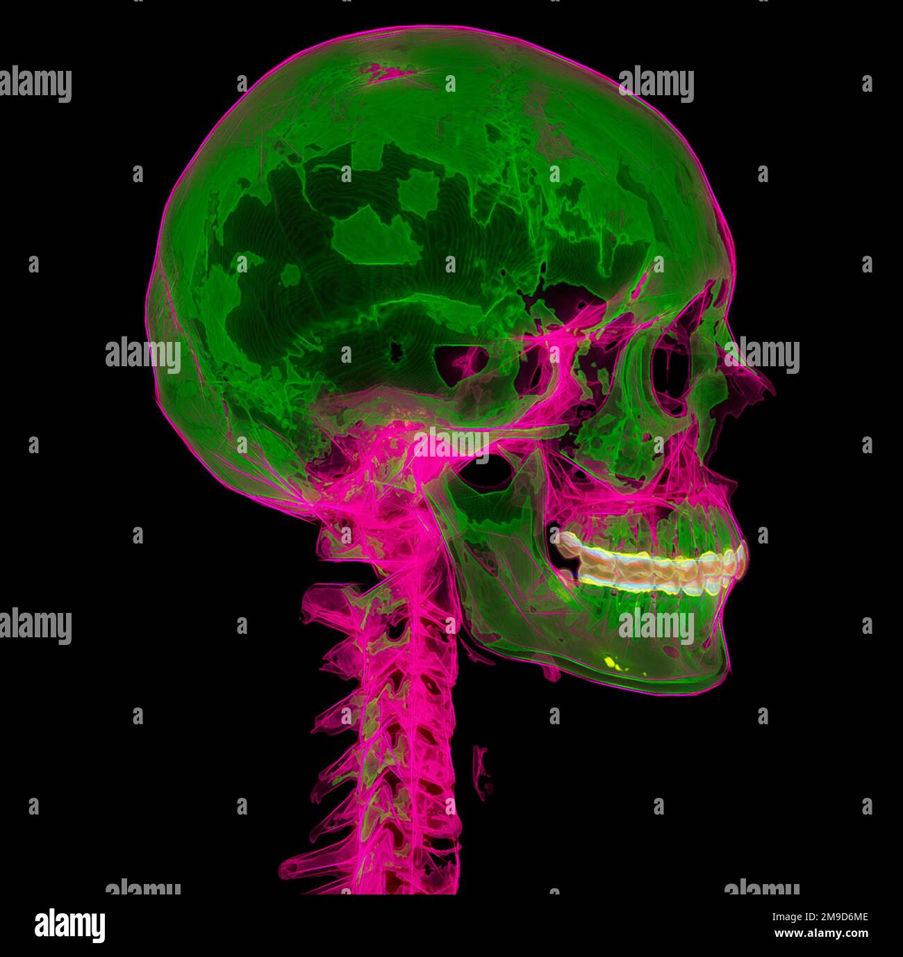 Head and neck bones, CT scan Stock Photo - Alamy