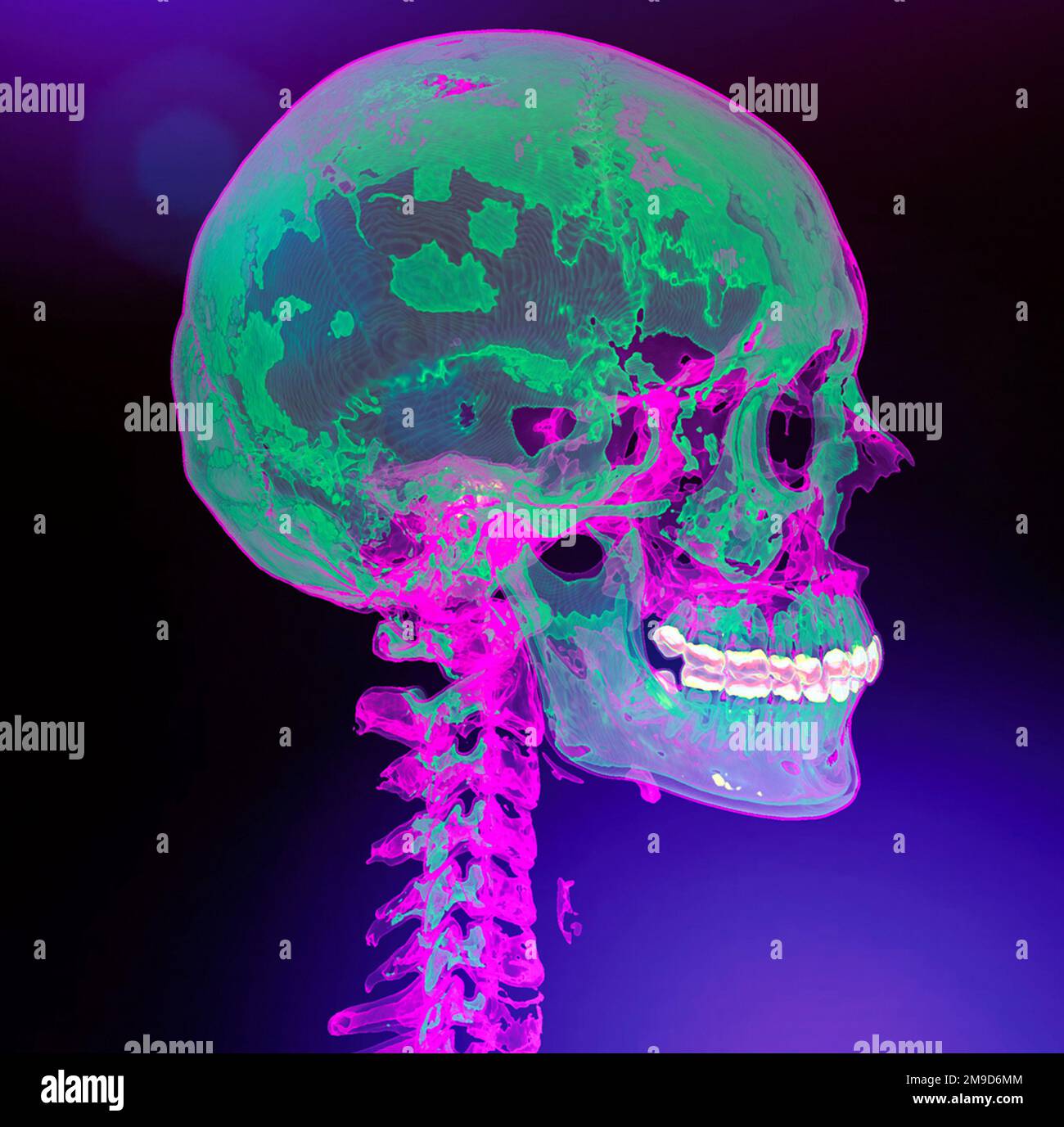 Head and neck bones, CT scan Stock Photo - Alamy