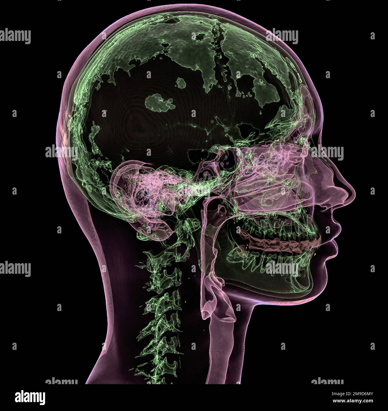 Head and neck bones, CT scan Stock Photo - Alamy