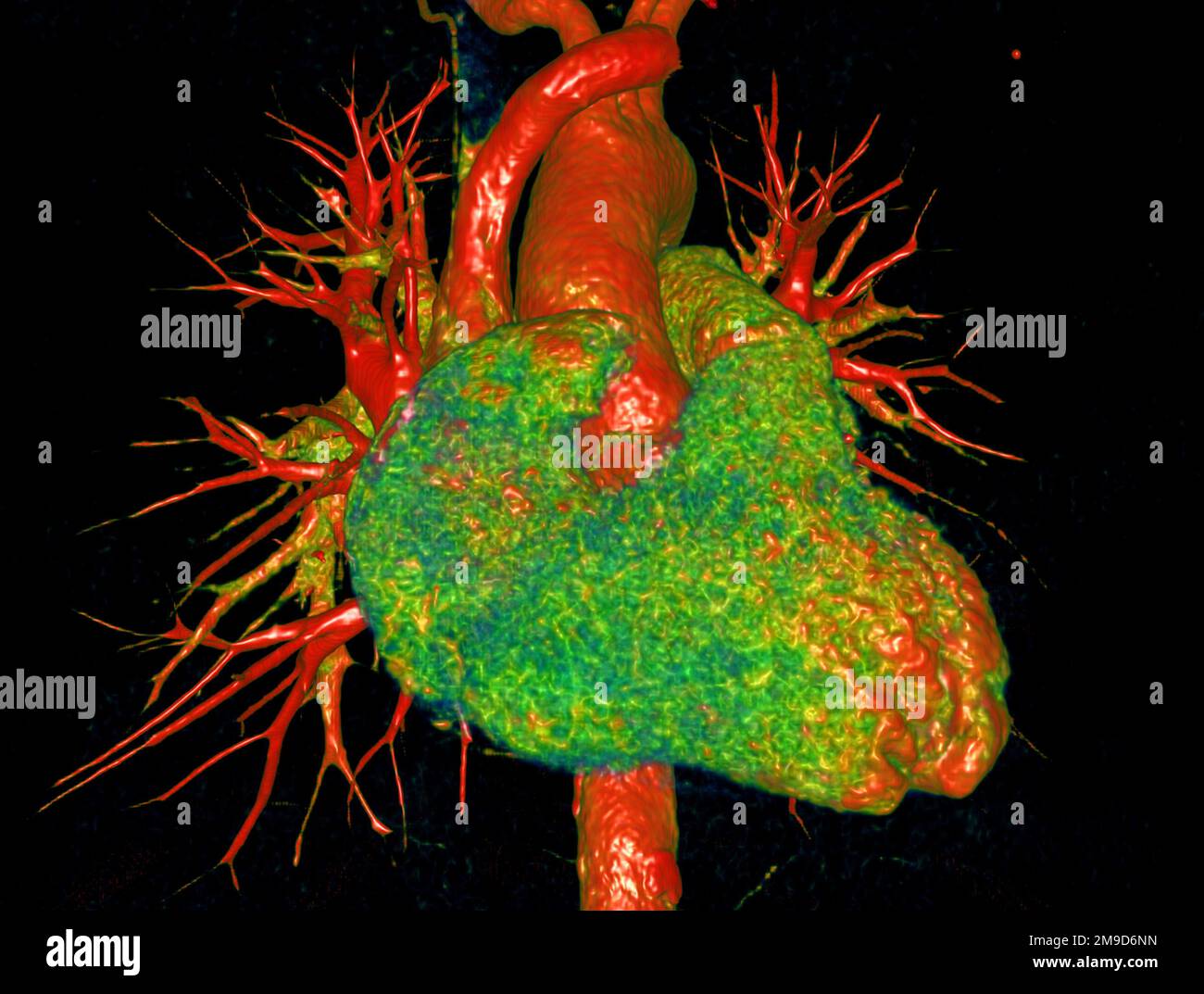 Healthy heart, CT scan Stock Photo - Alamy