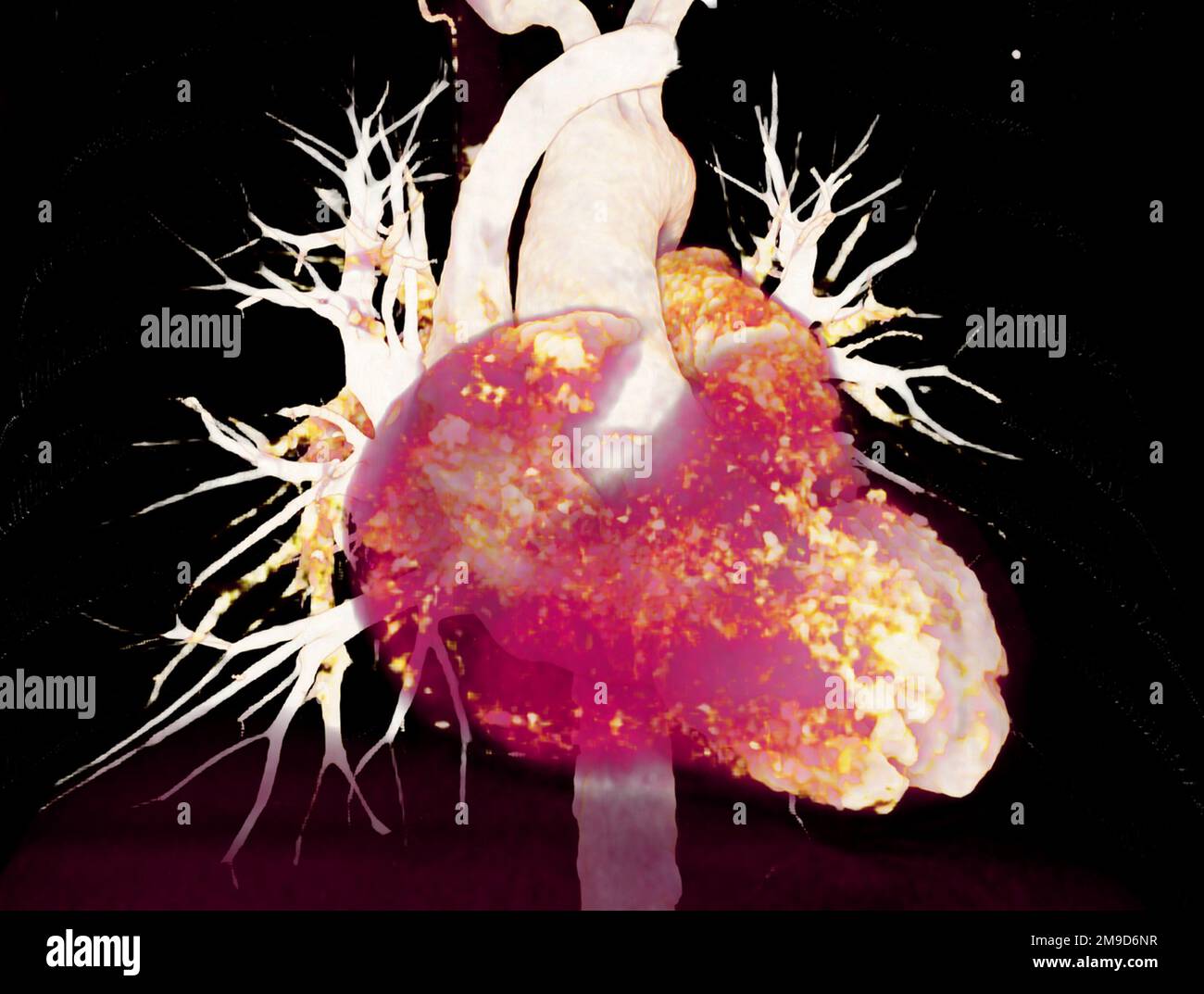 Healthy heart, CT scan Stock Photo - Alamy