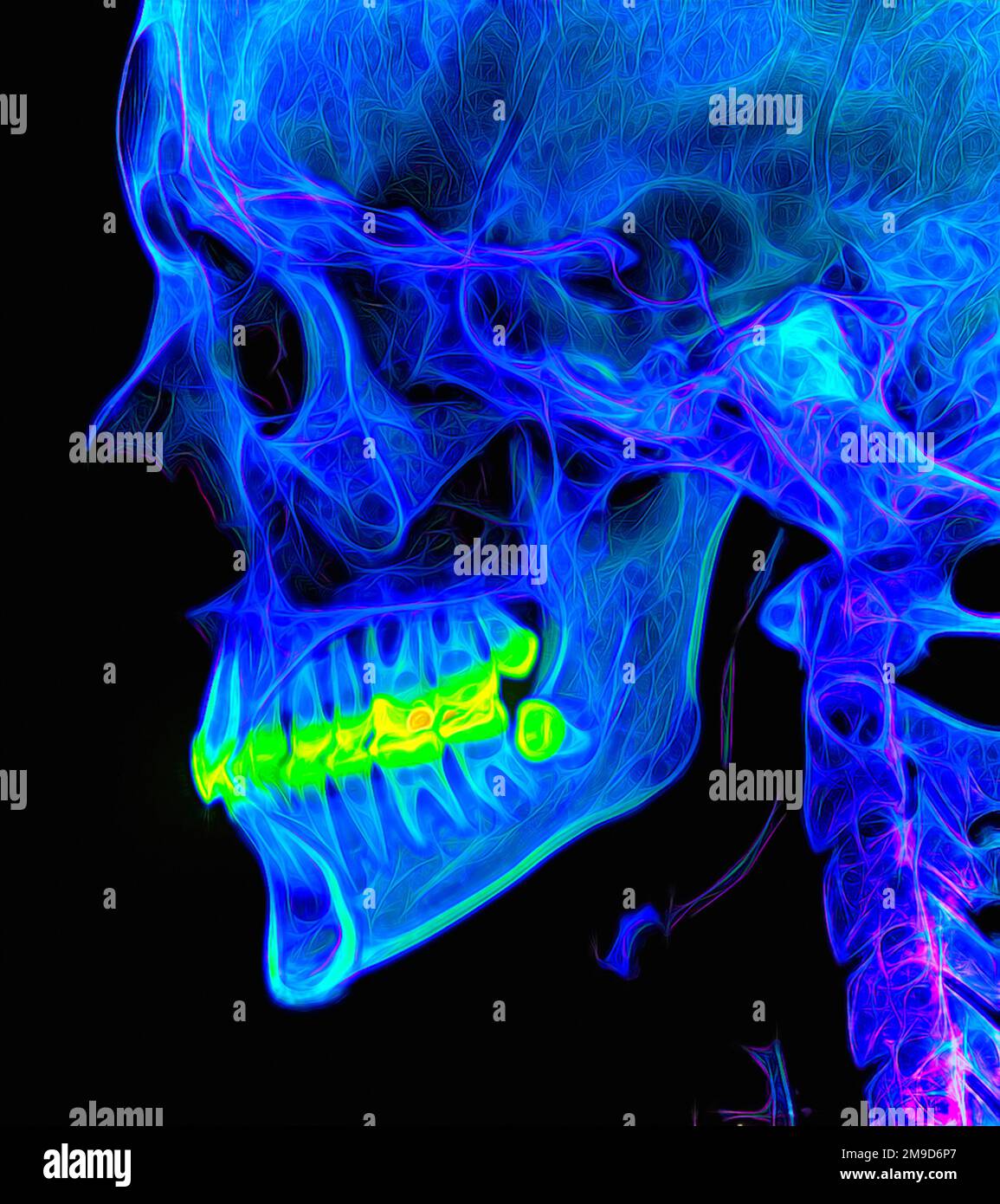 Head and neck bones, CT scan Stock Photo - Alamy