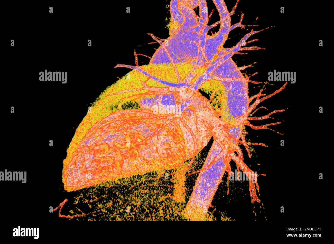 Healthy heart, CT scan Stock Photo - Alamy