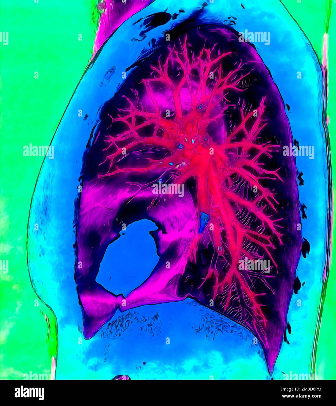 Healthy lung, CT scan Stock Photo - Alamy