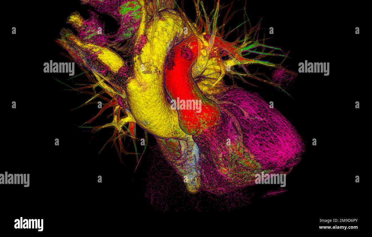 Healthy heart, CT scan Stock Photo - Alamy