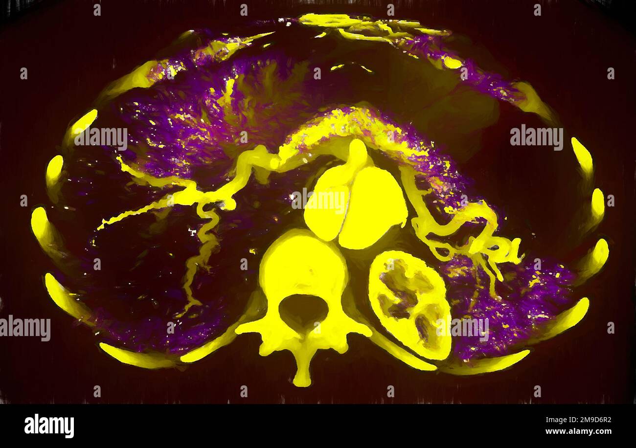 Aortic dissection, CT scan Stock Photo - Alamy