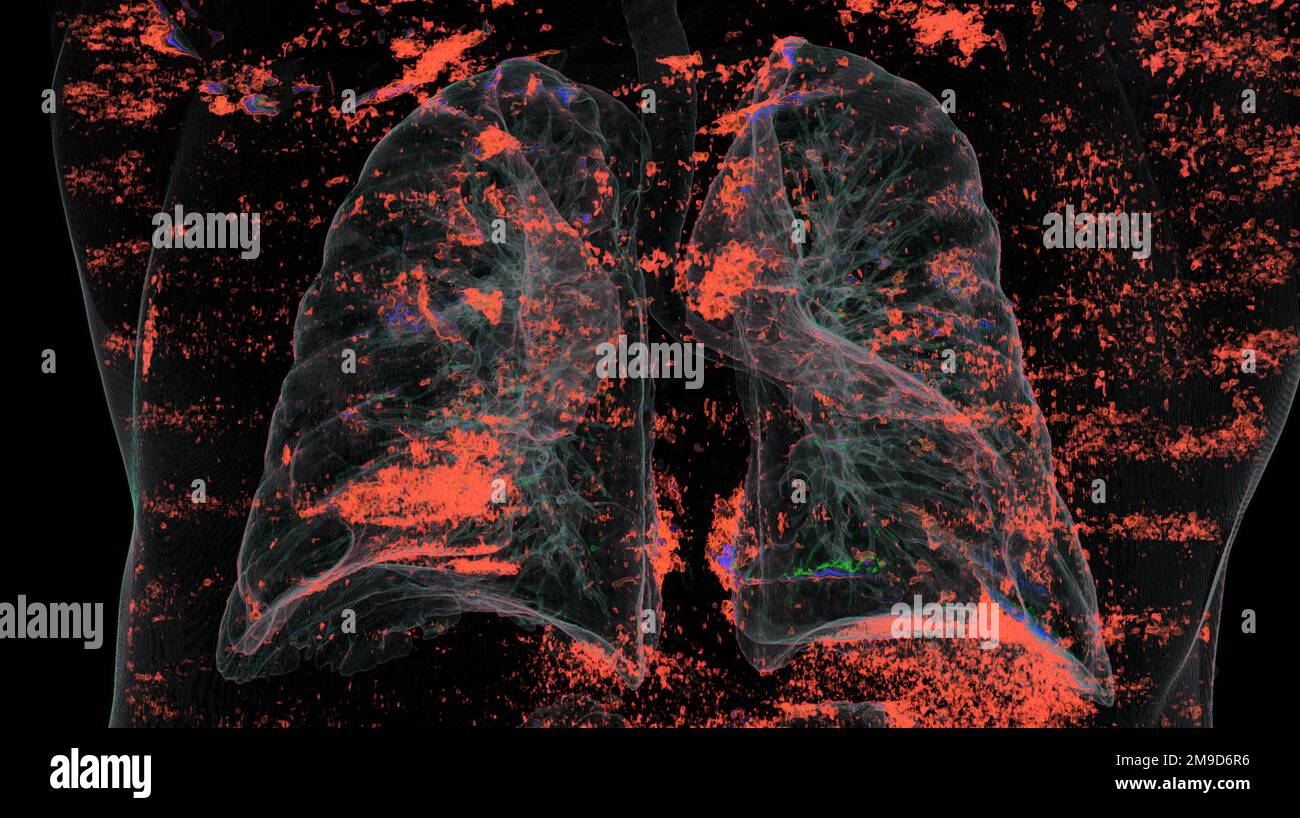 Healthy lungs, CT scan Stock Photo - Alamy