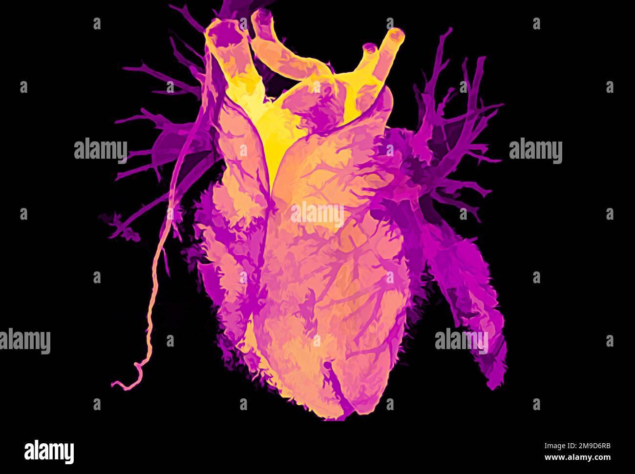 Healthy heart, CT scan Stock Photo - Alamy