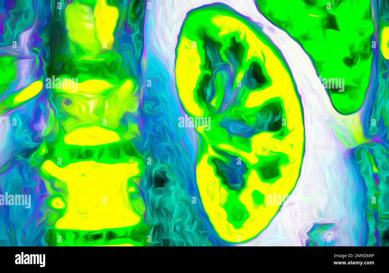 Kidney, CT scan Stock Photo - Alamy