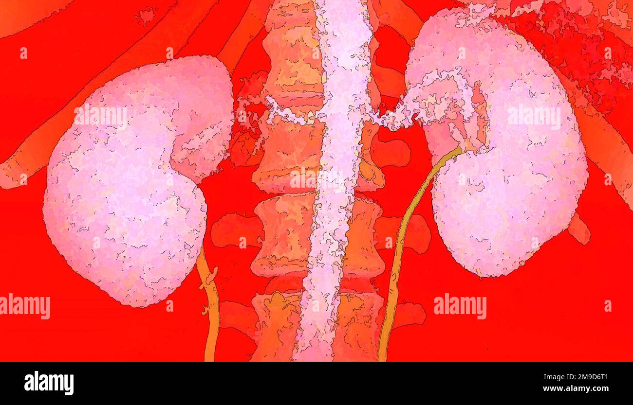 Kidneys, CT scan Stock Photo - Alamy