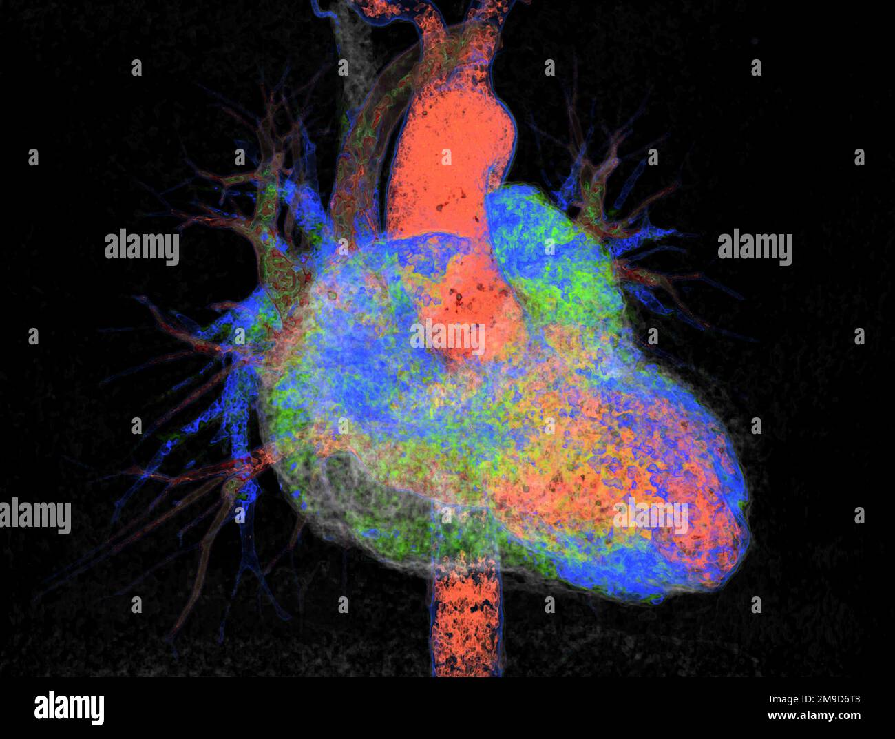 Healthy heart, CT scan Stock Photo - Alamy