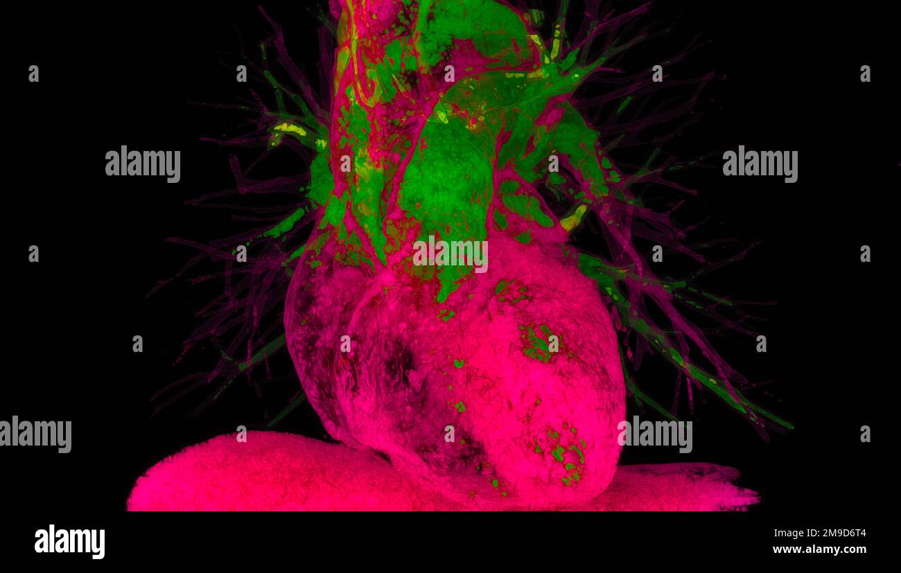 Healthy heart, CT scan Stock Photo - Alamy